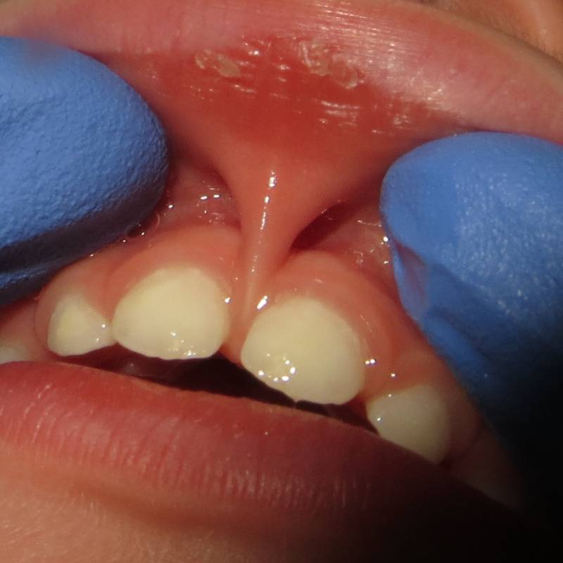 Children's Lip & Tongue Ties | Horizon Dental